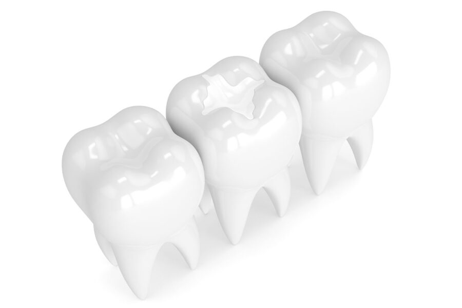 Metal-Free Fillings in Sierra Madre, CA | Sierra Madre Dentistry
